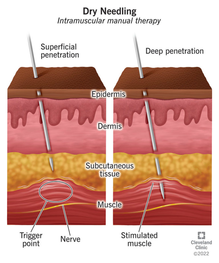 Dry Needling Treatment